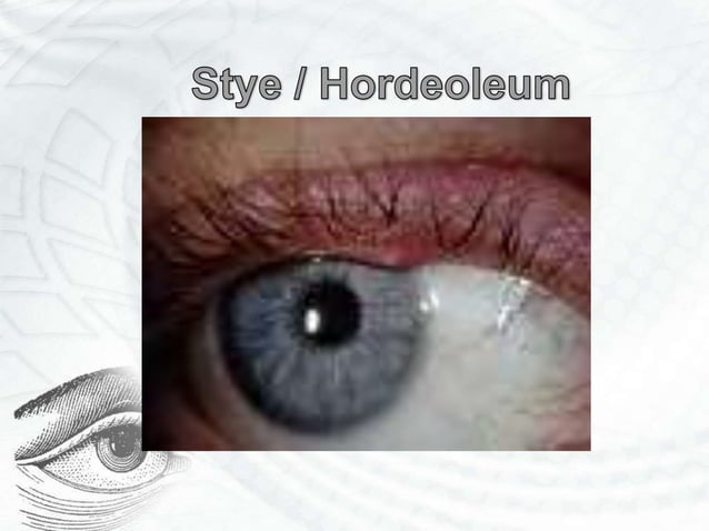 Approach to red eye | PPT