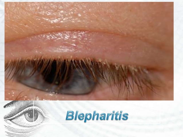 Approach to red eye | PPT