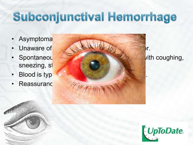 Approach to red eye | PPT