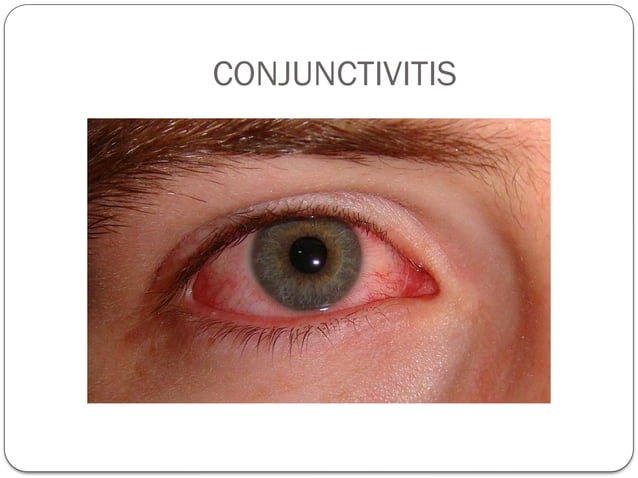 Approach to RED EYE and eye diseases pptx | PPT