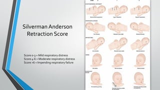 Approach to Respiratory Distress in Children By Essam Sidqi | PDF