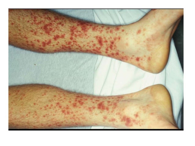 APPROACH TO RICKETTSIAL INFECTIONS-2.pptx