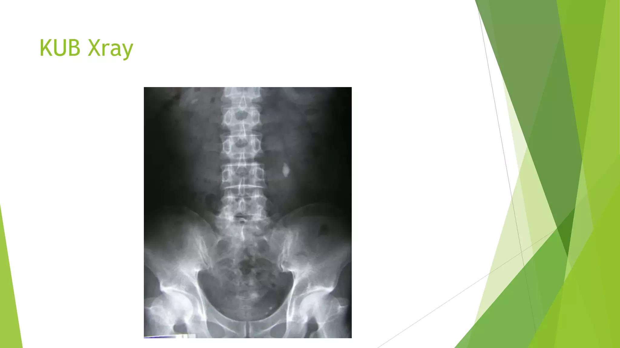 Approach to right iliac fossa(RIF) pain | PPTX