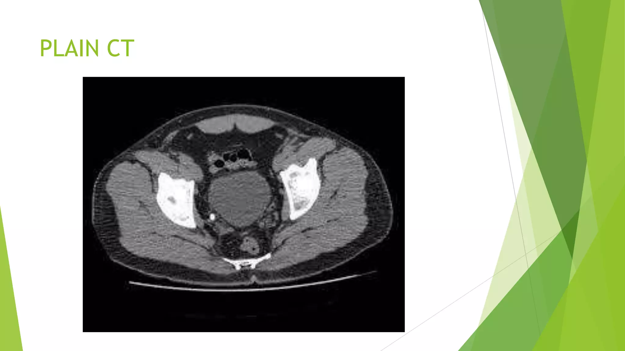 Approach to right iliac fossa(RIF) pain | PPTX
