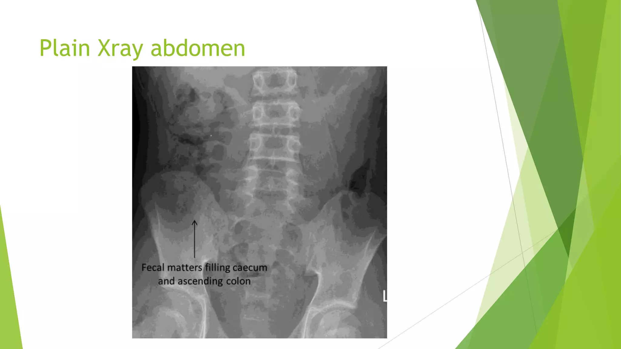 Approach to right iliac fossa(RIF) pain | PPTX