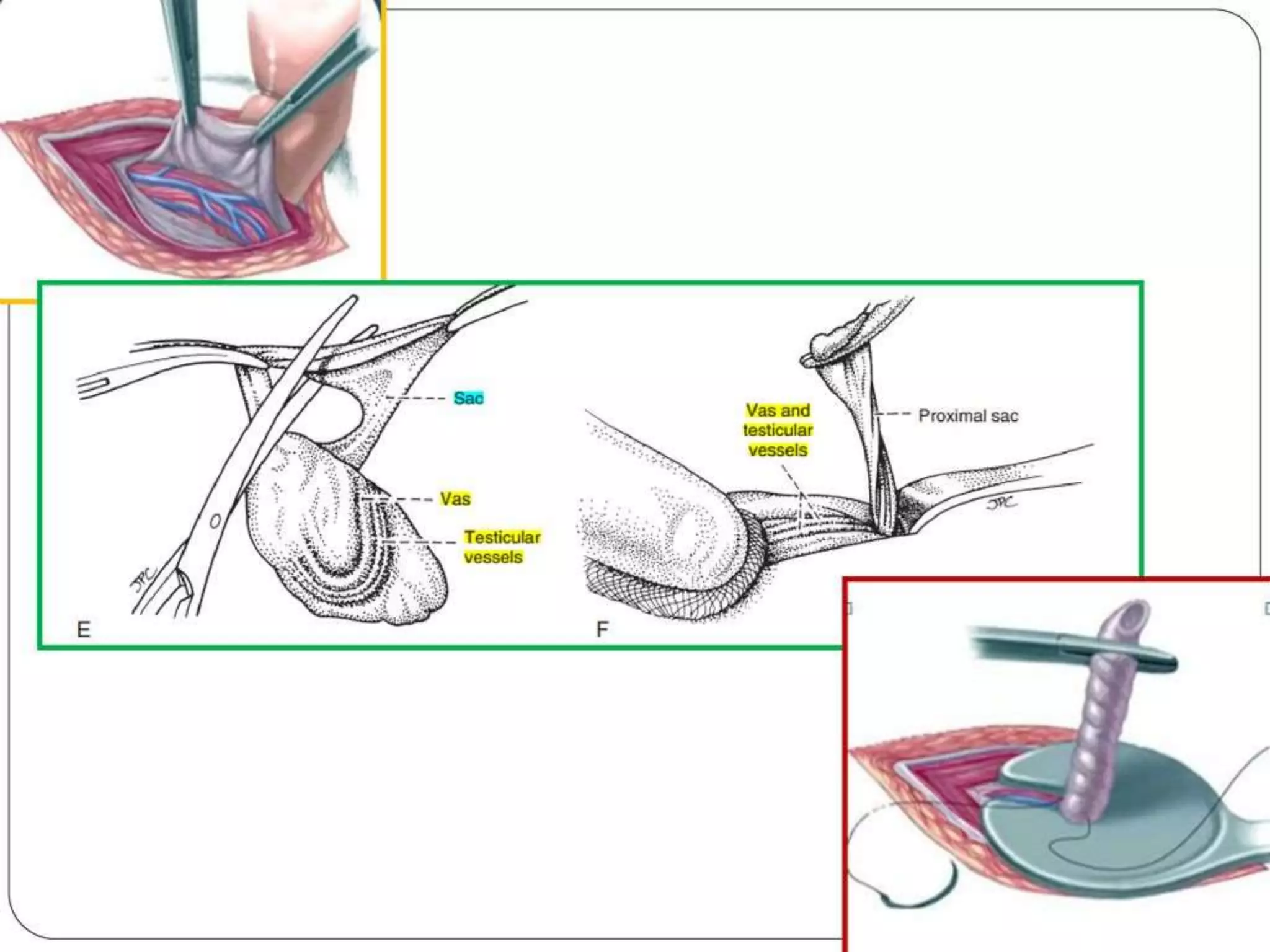 Approach to Scrotal Swelling.pptx | Infertility | Reproductive Health