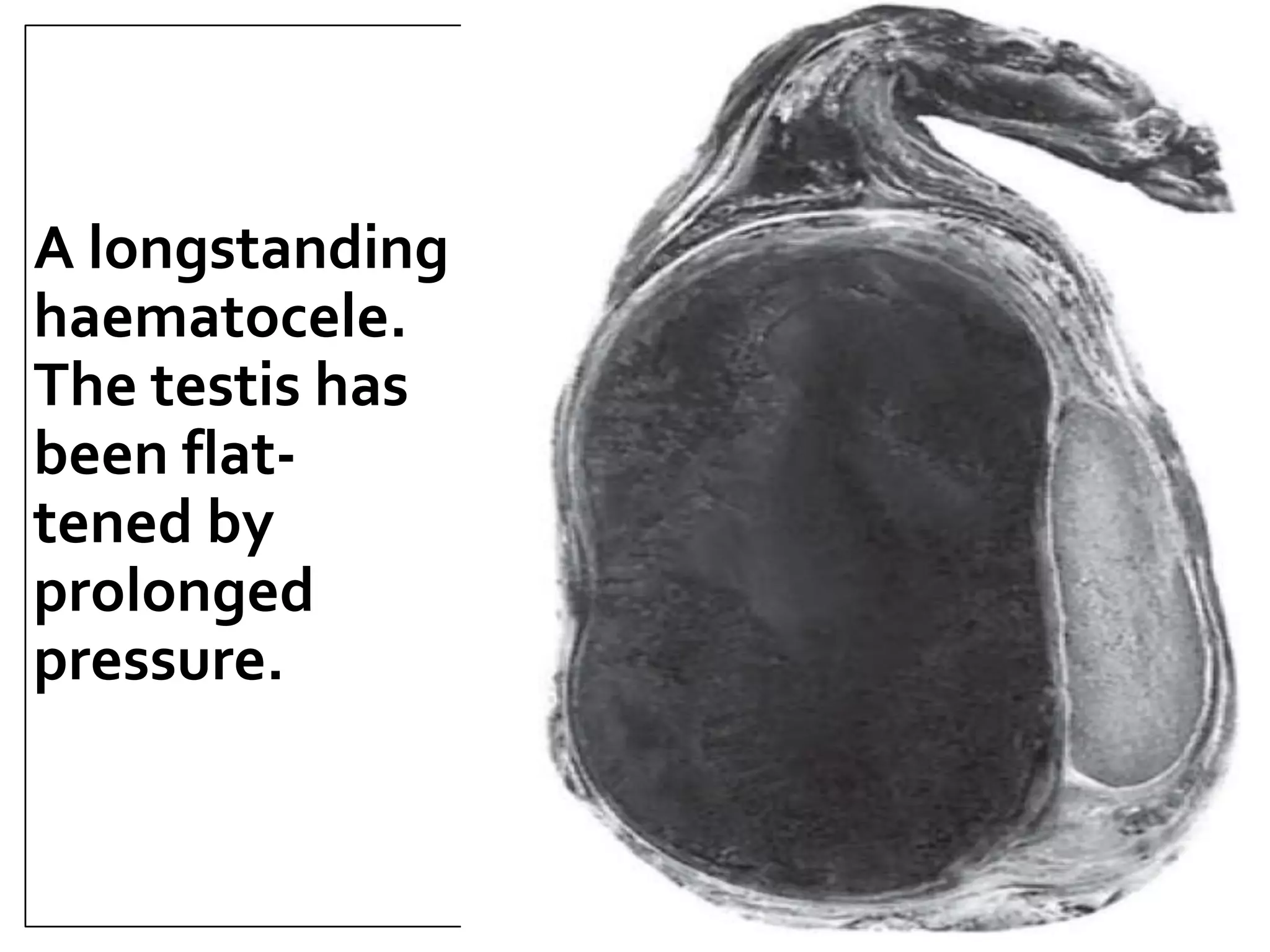 Approach to Scrotal Swelling.pptx