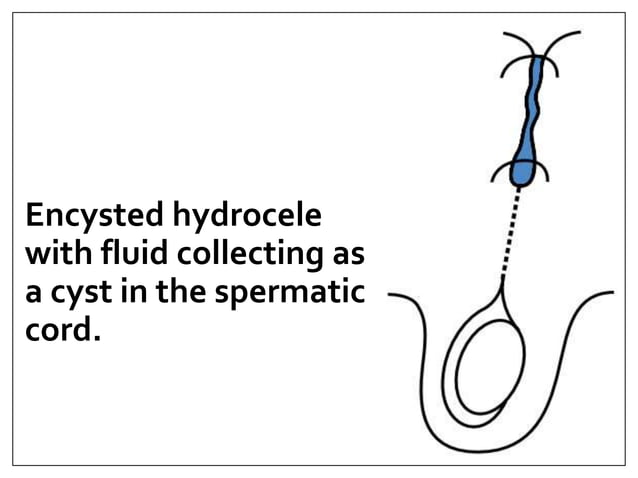 Approach to Scrotal Swelling.pptx | Infertility | Reproductive Health