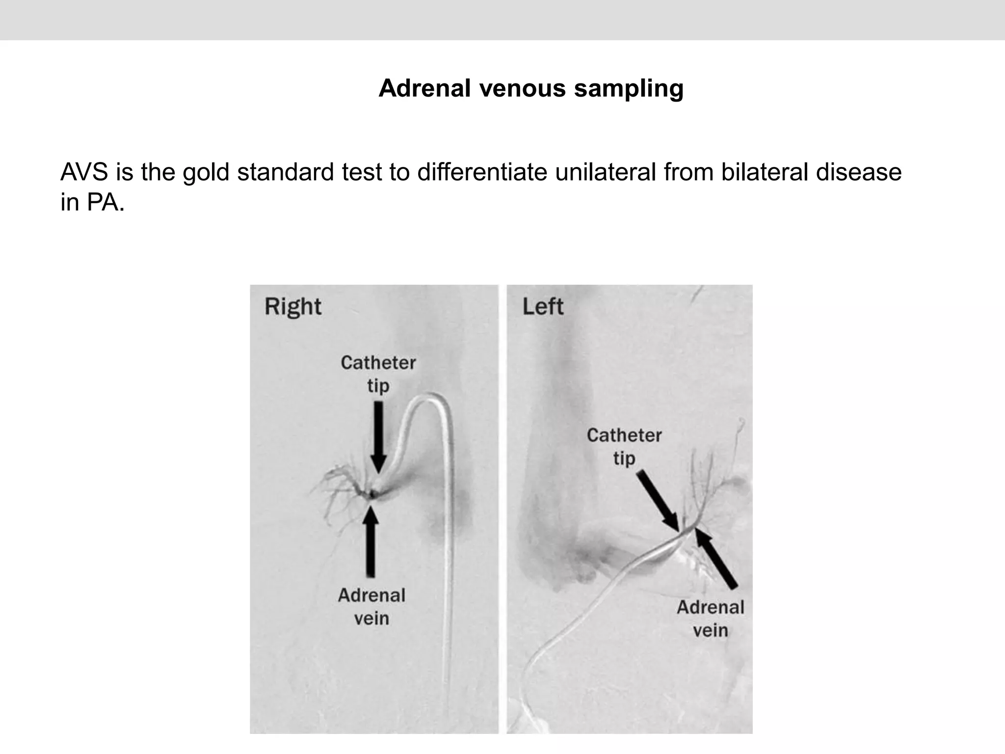 Approach to secondary hypertension in young patients | PPTX