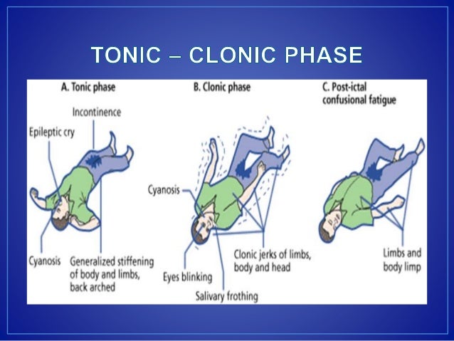 APPROACH TO SEIZURE CME