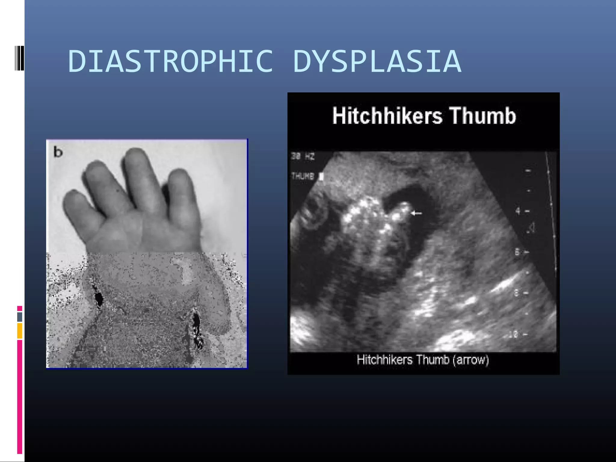 Approach to skeletal dysplasia | PPT | Bone and Joint Conditions ...