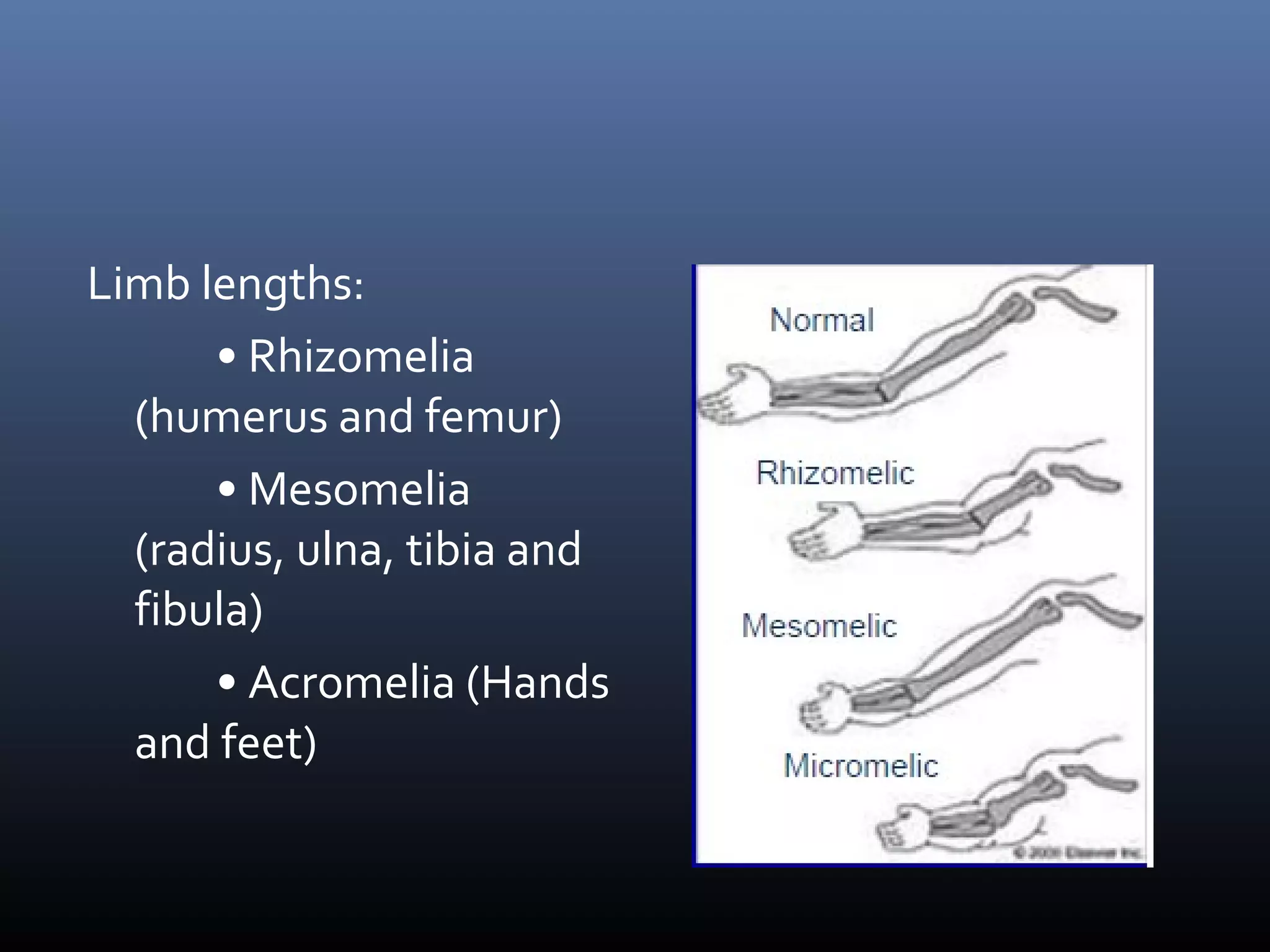 Approach to skeletal dysplasia | PPT