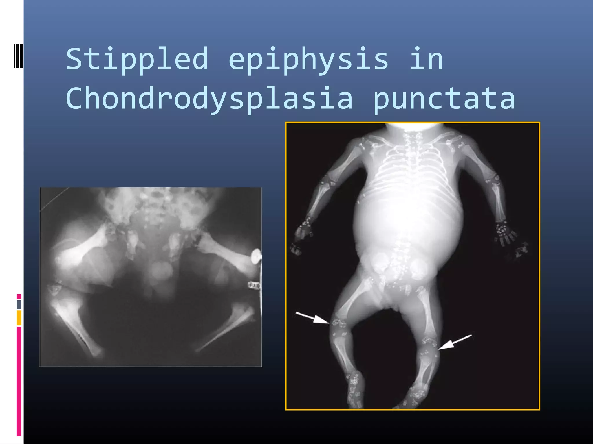 Approach to skeletal dysplasia | PPT