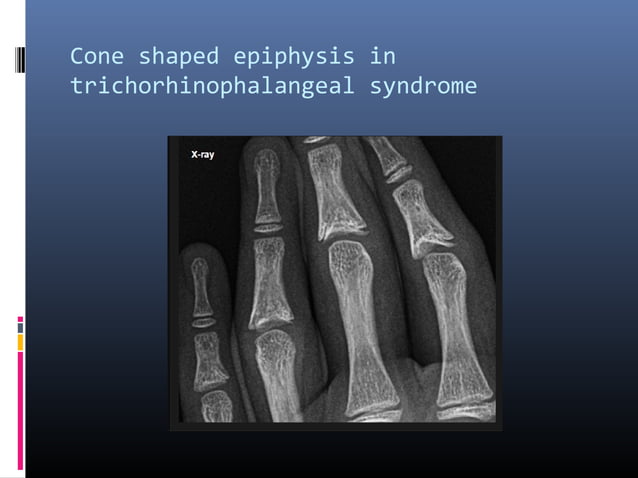Approach to skeletal dysplasia | PPT | Bone and Joint Conditions ...