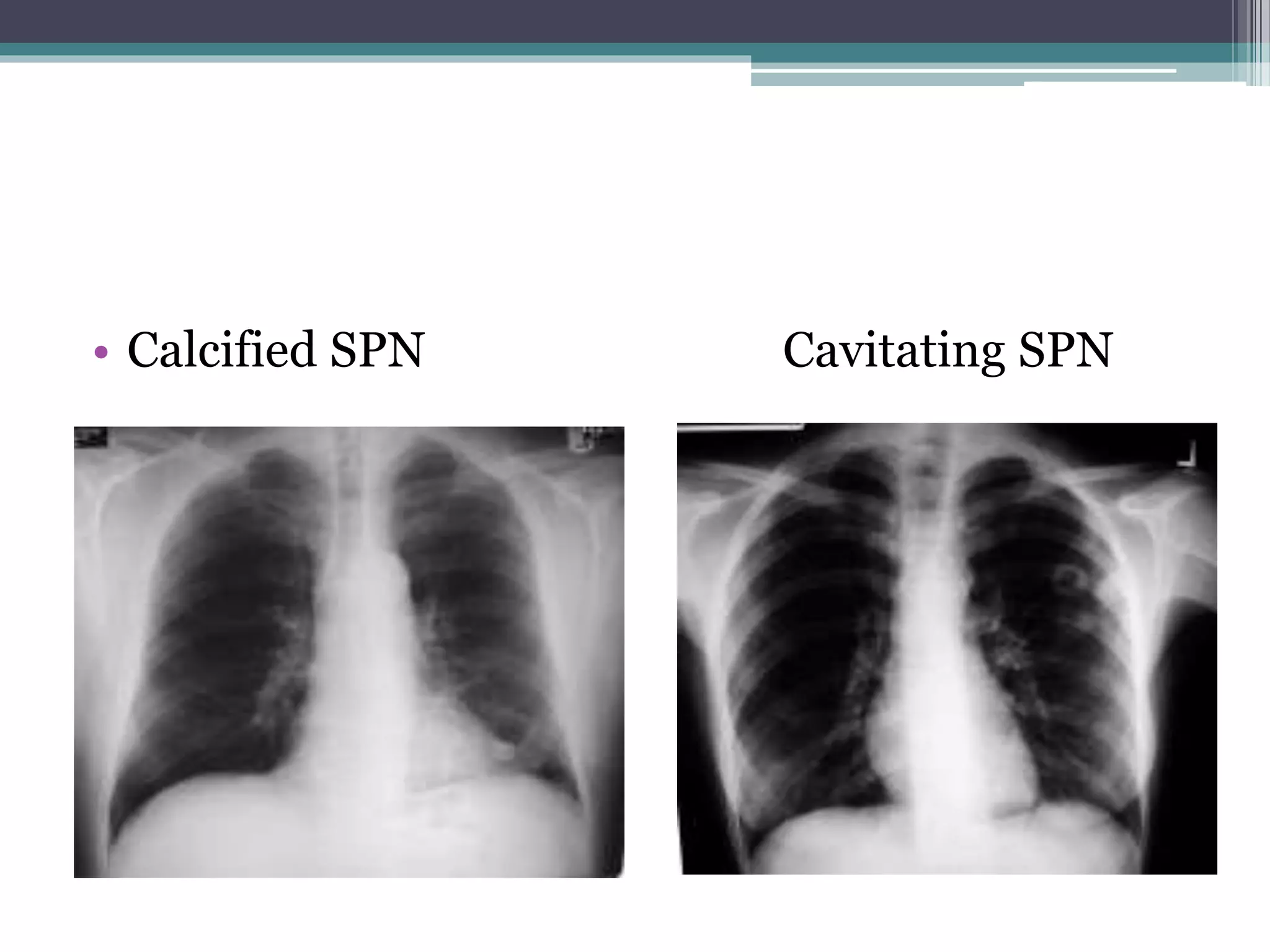 Approach to solitary pulmonary nodule | PPTX