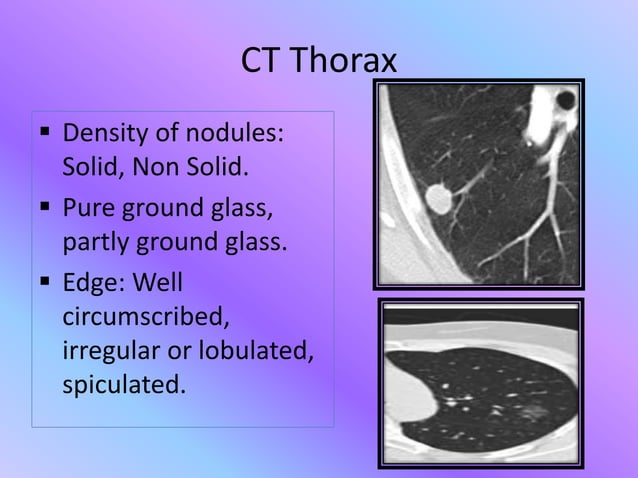 Approach To Solitary Pulmonary Nodule Pptx Lung And Respiratory Health Diseases And Conditions