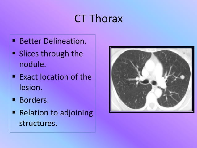 Approach to solitary pulmonary nodule | PPTX | Lung and Respiratory ...