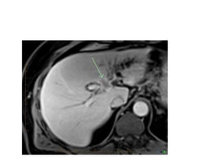 Approach to Surgical Jaundice.pptx