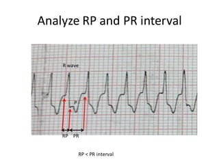 Approach to SVT ufhhchchchcjhcjfjjfuhf fhfhfufhu | PPT