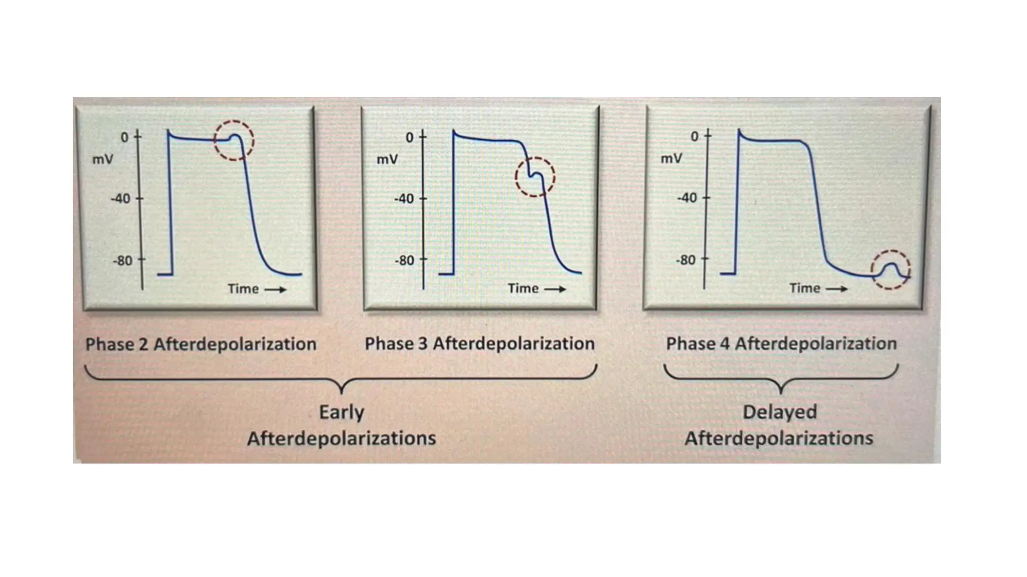 approach to Supraventricular tachycardia | PDF