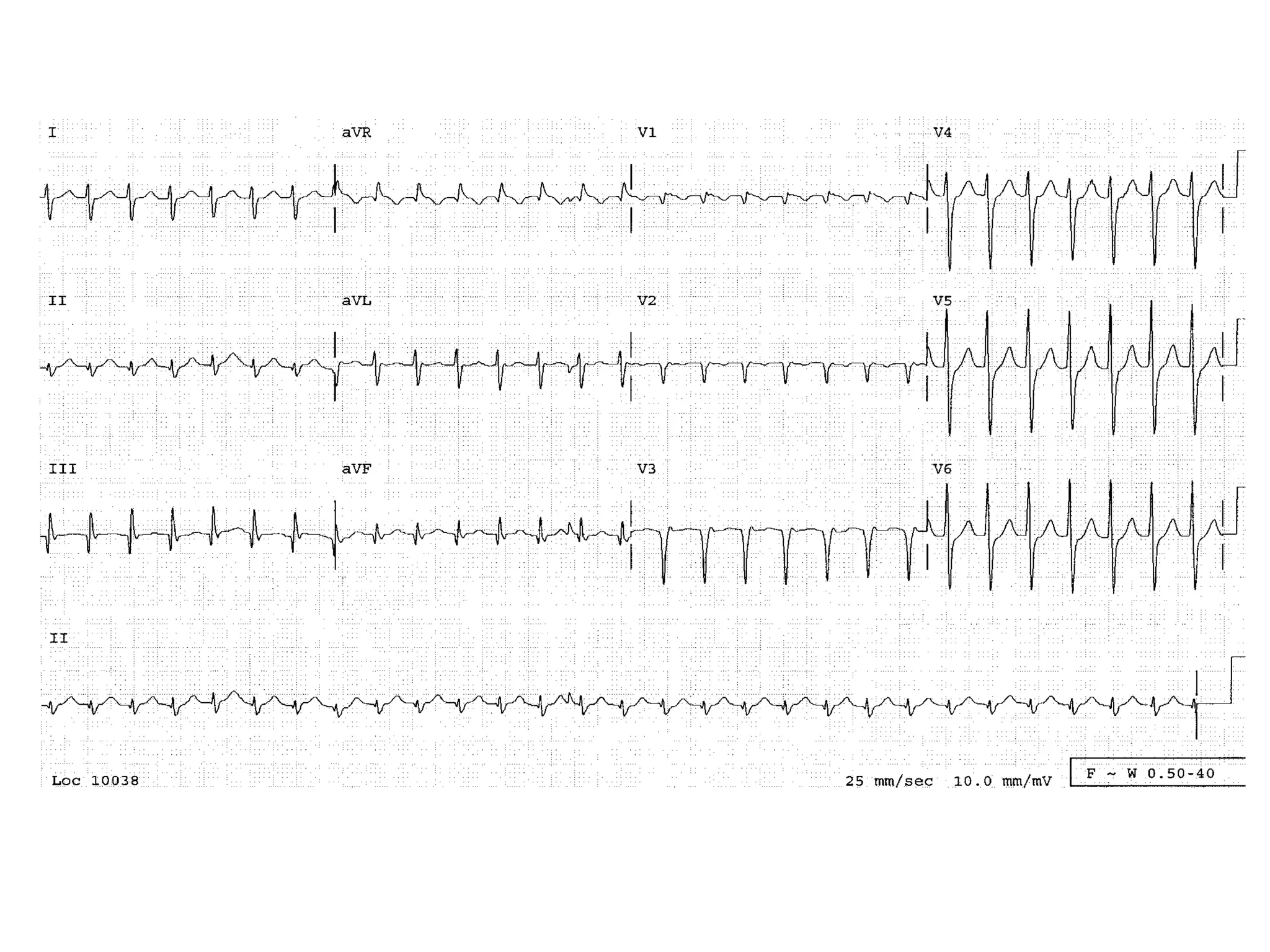 Approach to svt | PPT