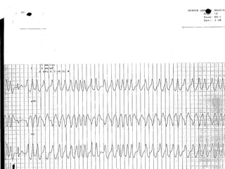 Approach to svt | PPT