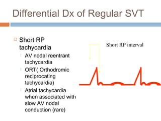 Approach to svt | PPT