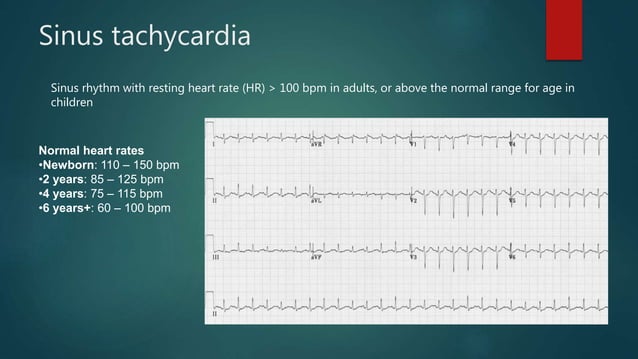 Approach to tachyarrhythmia | PPTX | Heart and Cardiovascular Diseases ...