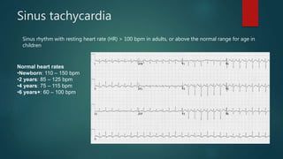 Approach to tachyarrhythmia