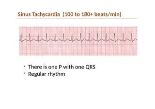 Approach to tachycardia in emergency department | PPTX