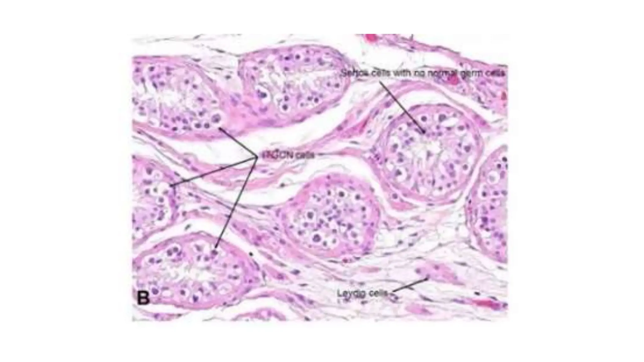 Approach to Testicular Biopsy.........pptx