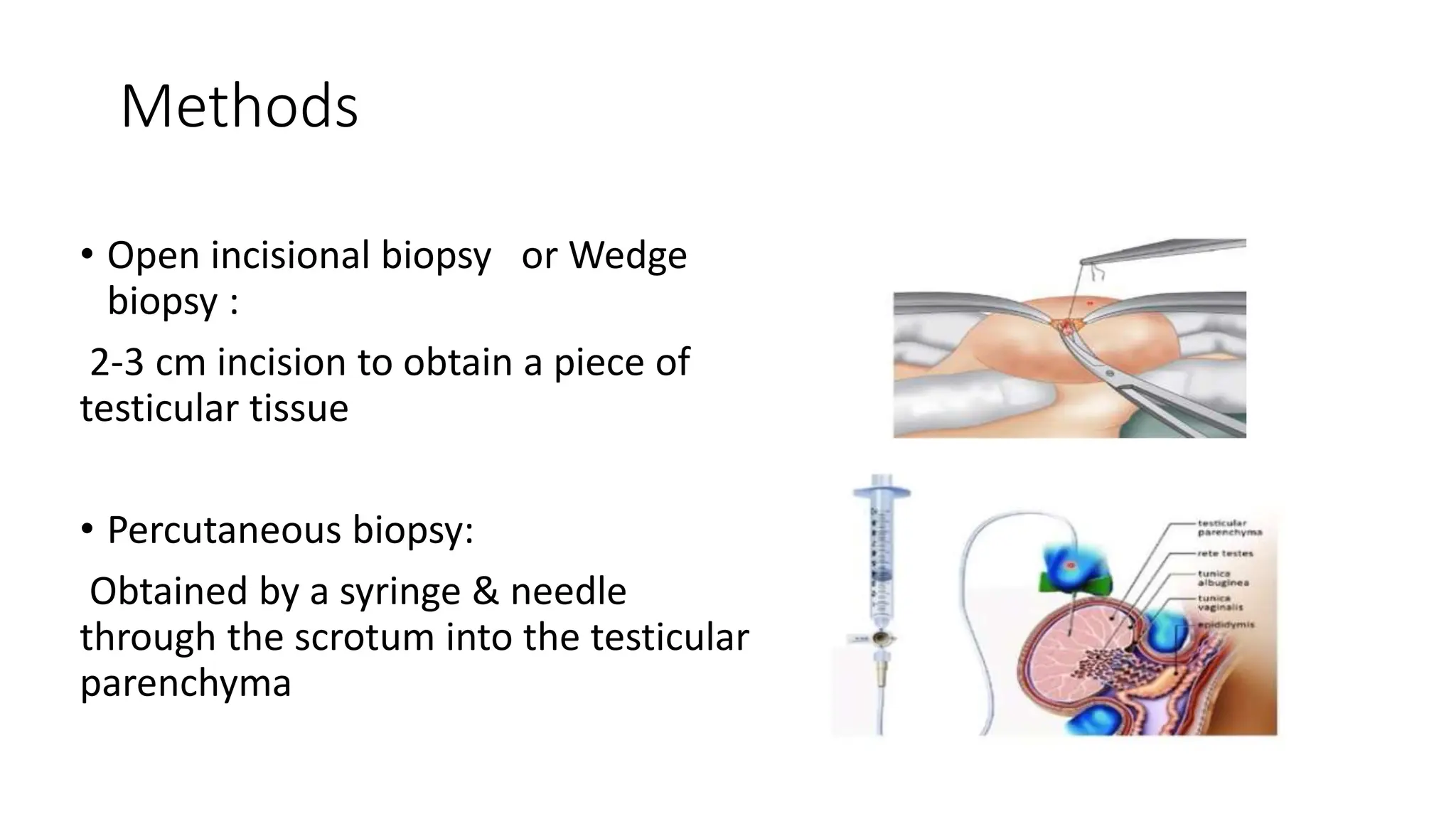 Approach to Testicular Biopsy.........pptx