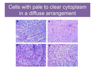Approach to testicular tumors | PPTX