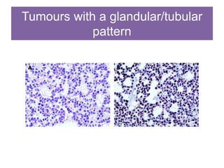 Approach to testicular tumors | PPTX