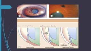 Approach to the case of pacg | PPTX