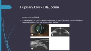 Approach to the case of pacg | PPTX
