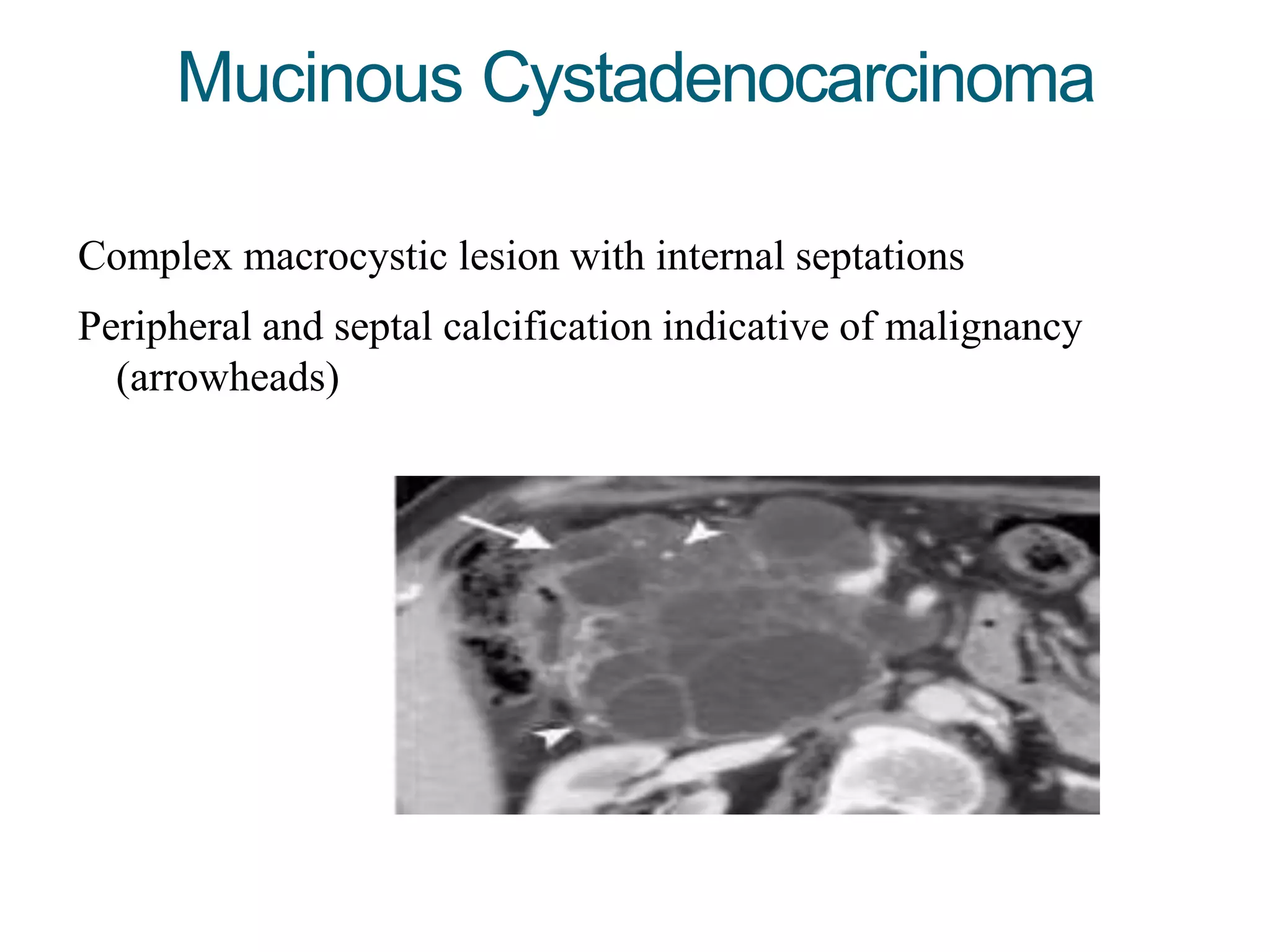 Approach to the cystic lesion of pancrease | PPTX