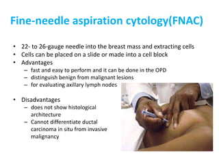 Approach to the diagnosis of a breast lump | PPTX
