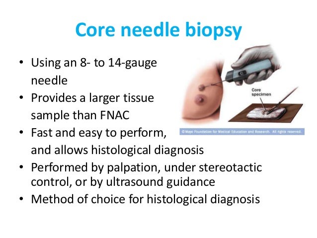 Approach to the diagnosis of a breast lump