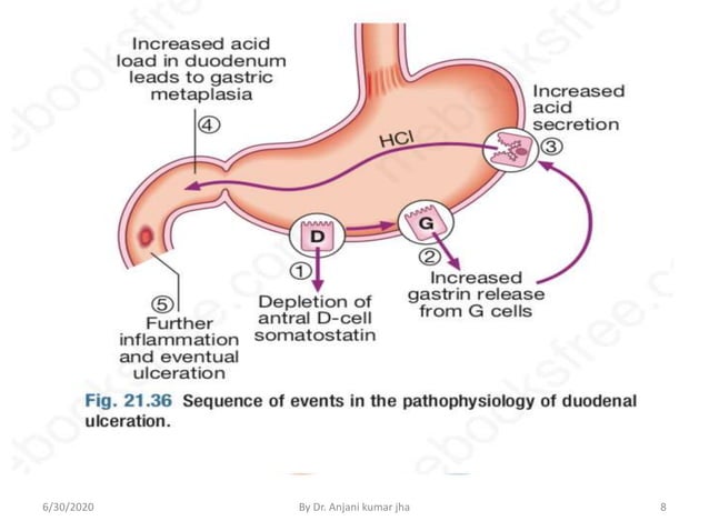 Approach to the management of peptic ulcer disease | PPTX