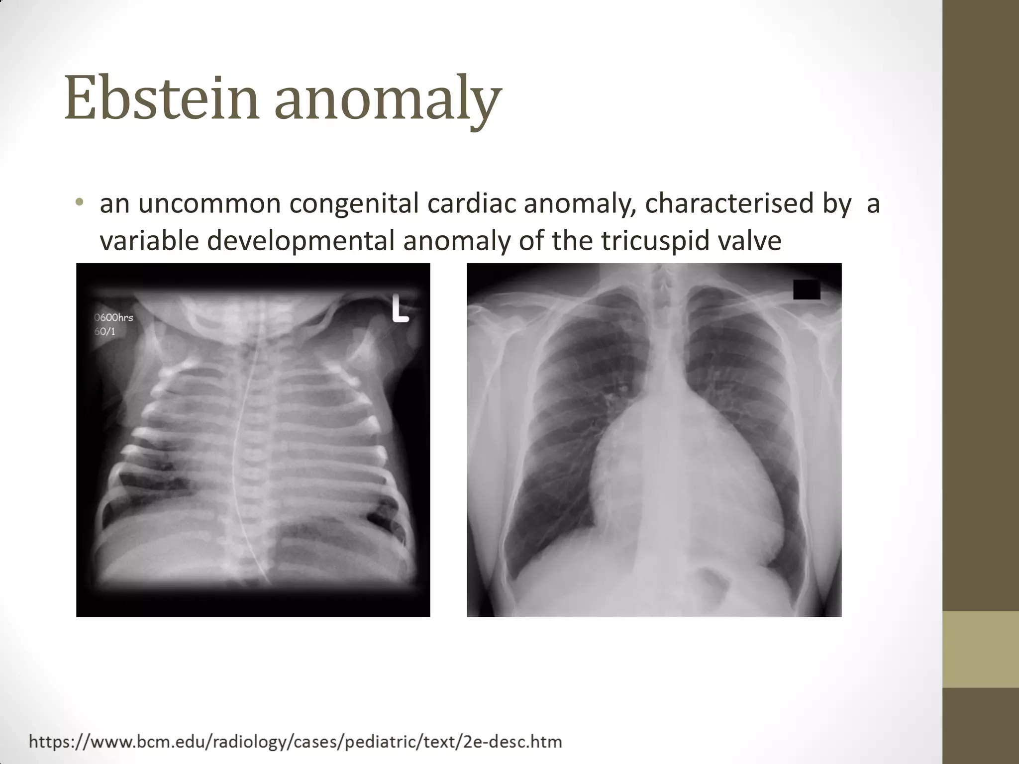Approach to the neonatal cyanosis | PDF