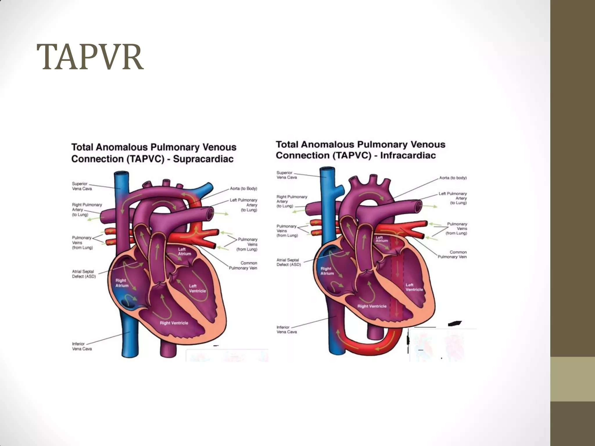 Approach to the neonatal cyanosis | PDF