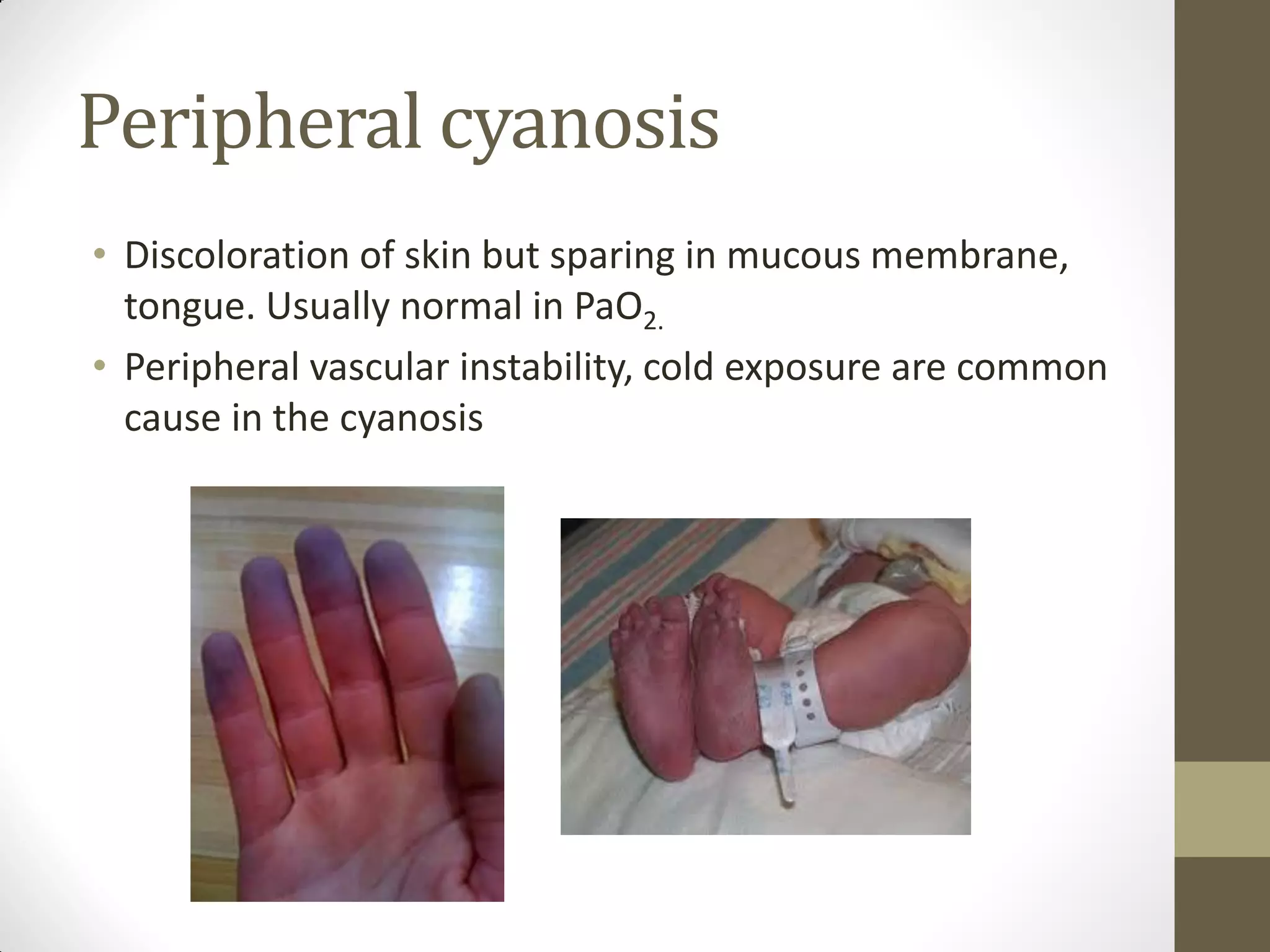 Approach to the neonatal cyanosis | PDF