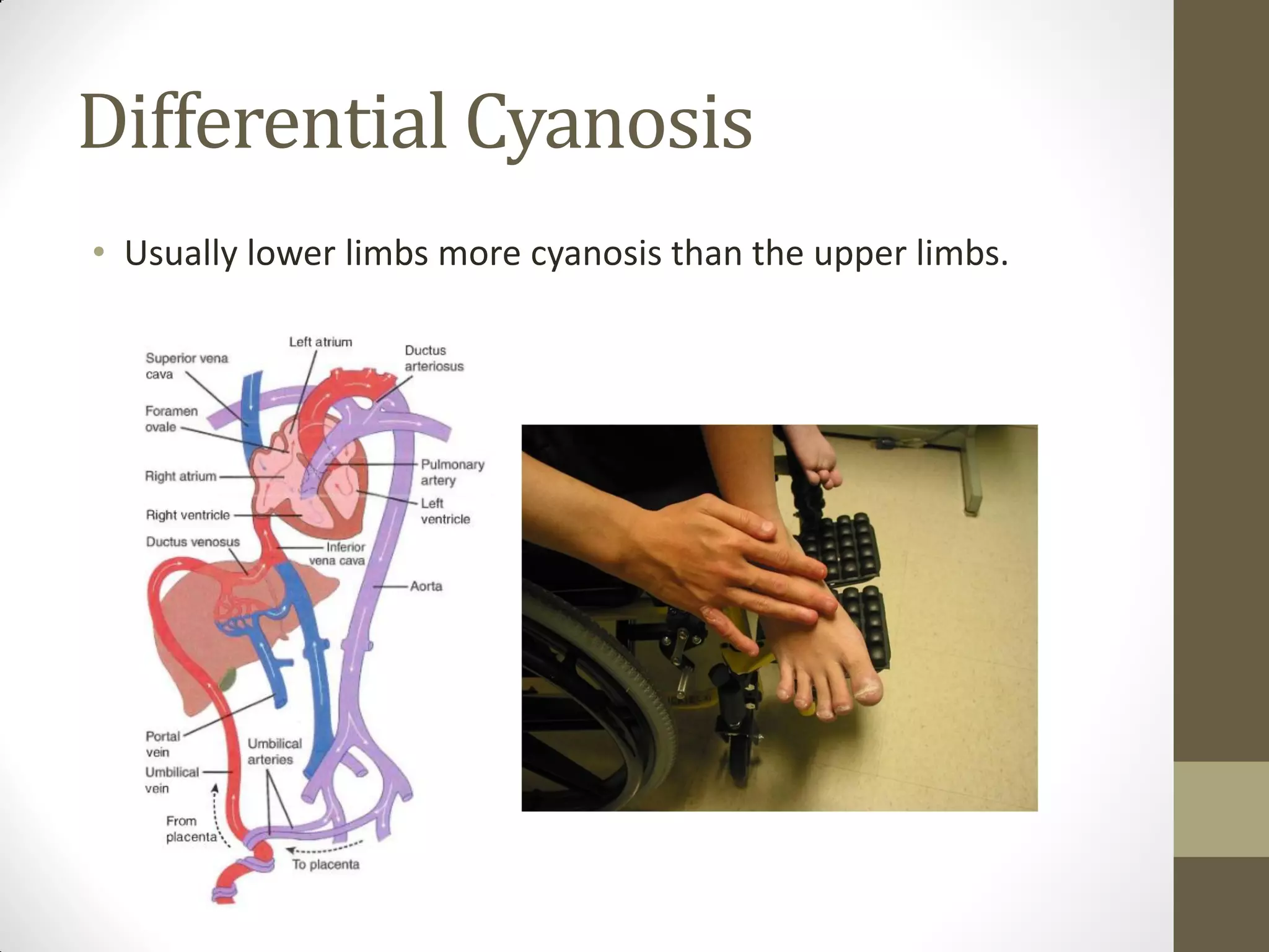 Approach to the neonatal cyanosis | PDF