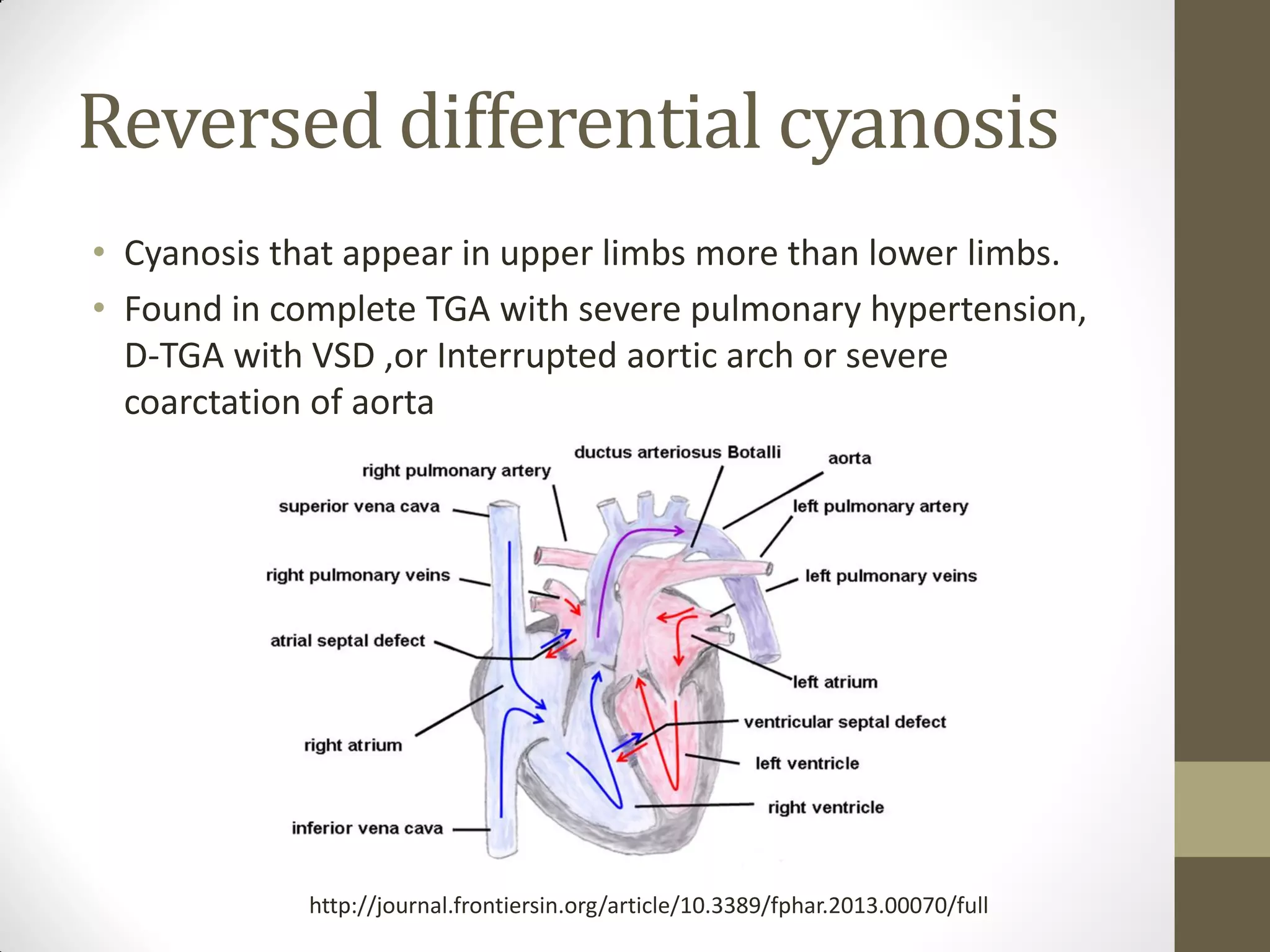 Approach to the neonatal cyanosis | PDF
