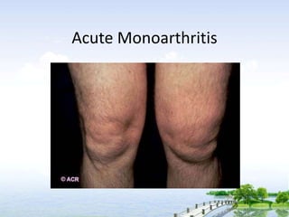 Approach to the patient with arthritis | PPTX