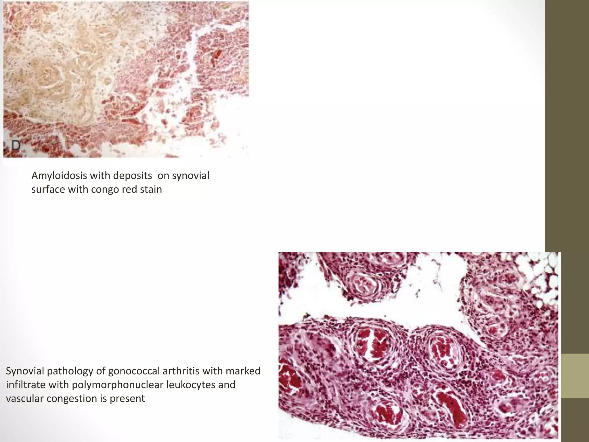 Approach to the patient with arthritis | PPTX