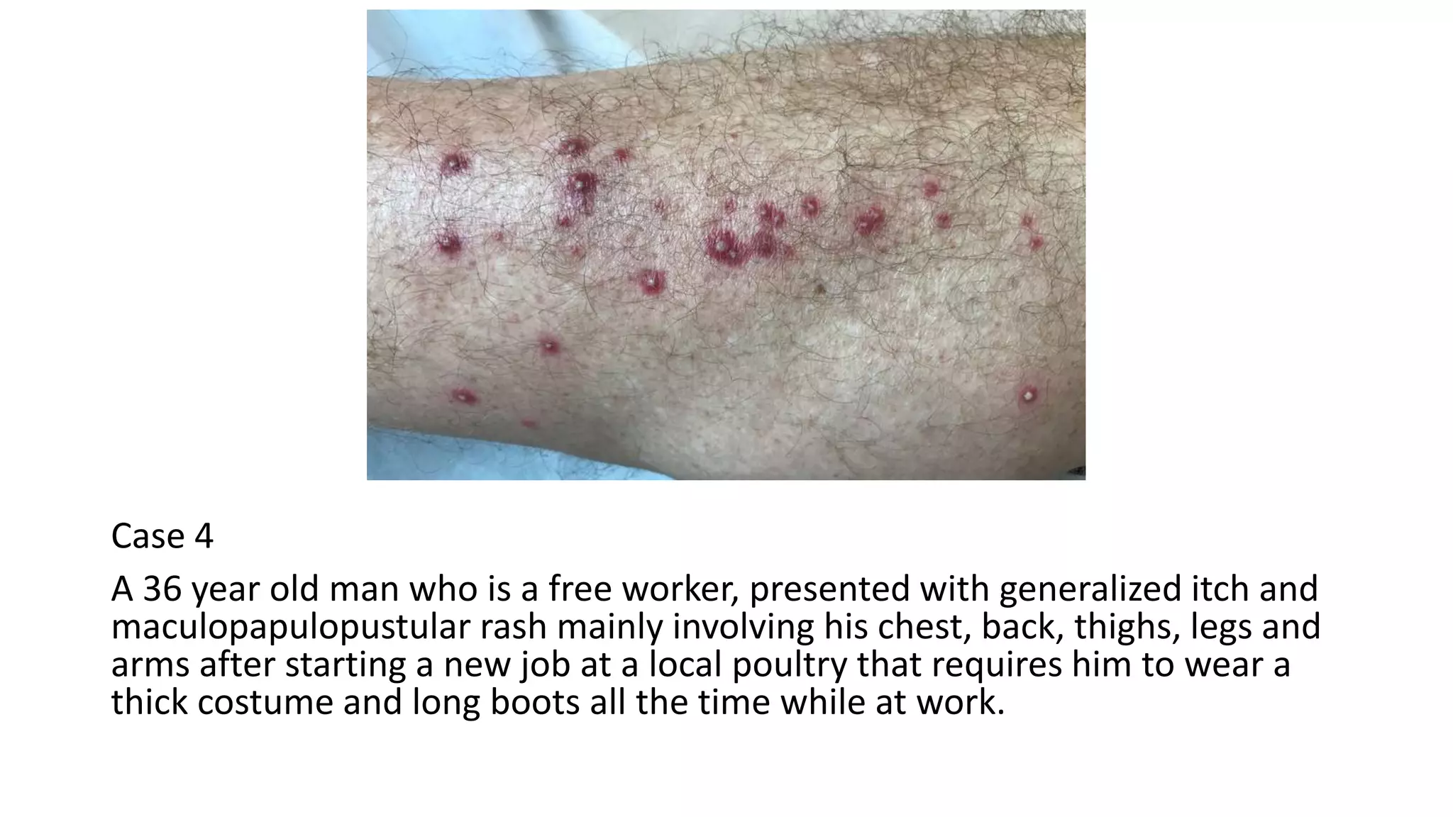 Approach to the patient with pruritus | PPTX