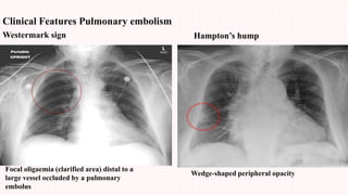 Approach to Thromboembolism II-1.pdf university of Zambia | PPT