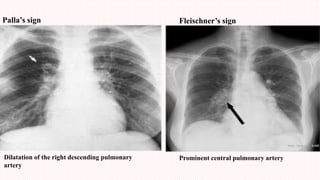 Approach to Thromboembolism II-1.pdf university of Zambia | PPT
